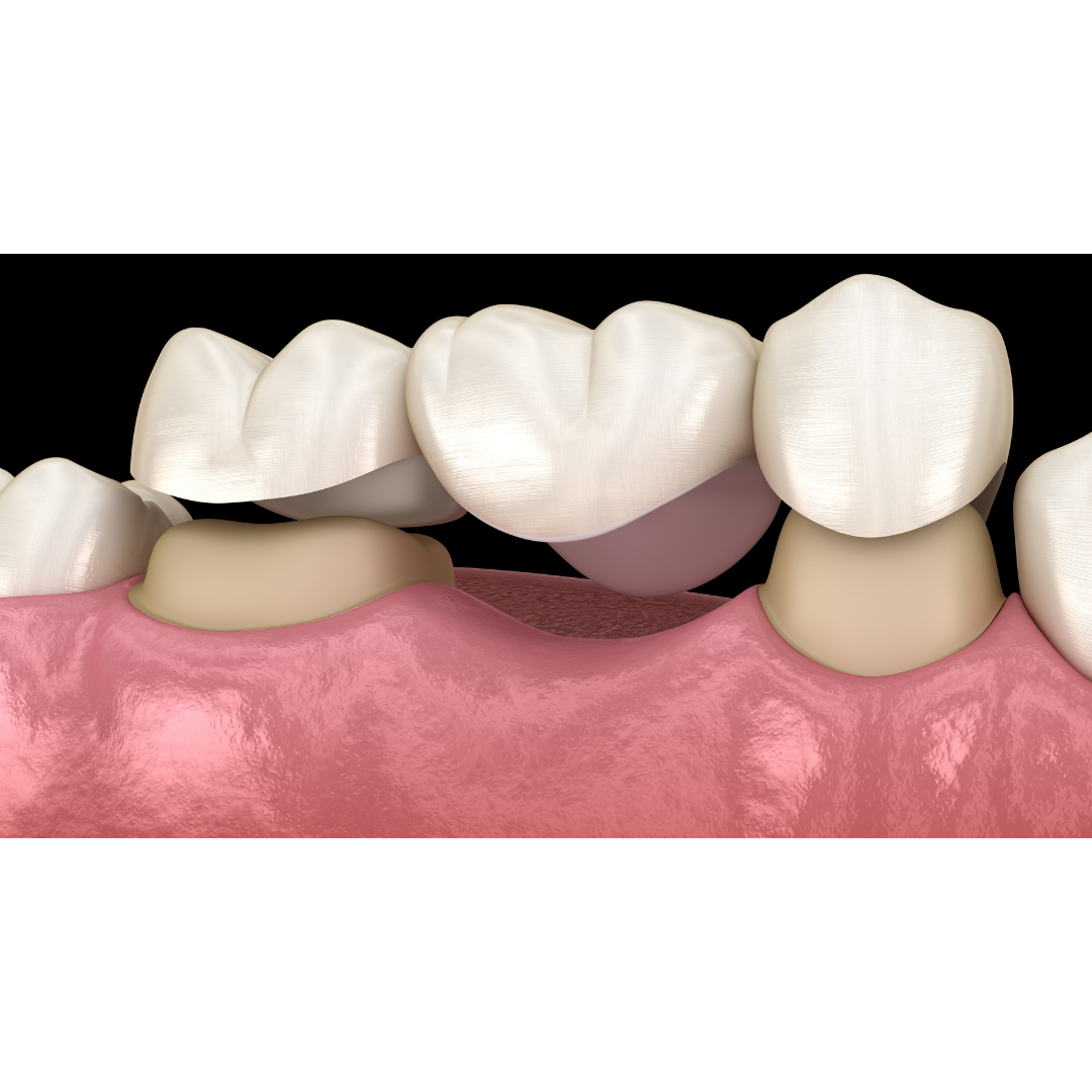 Bridge the Gap: Clearwater Dental Bridges